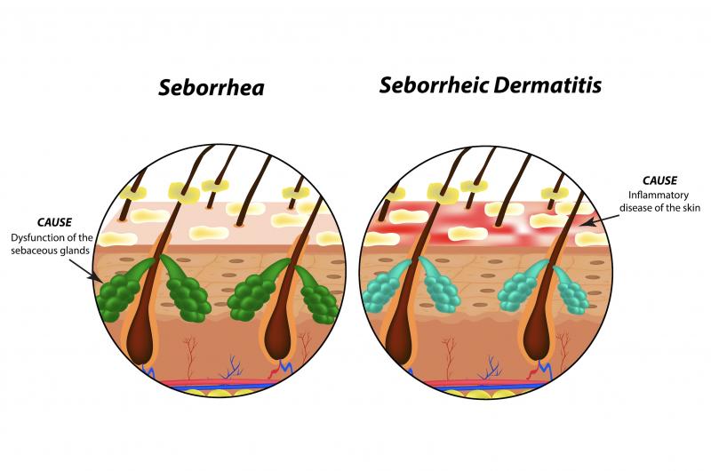 Zoom sur la dermatite séborrhéique du cuir chevelu avec le CIDP ...